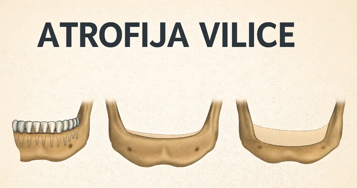 Atrofija vilice - Zubar Beograd