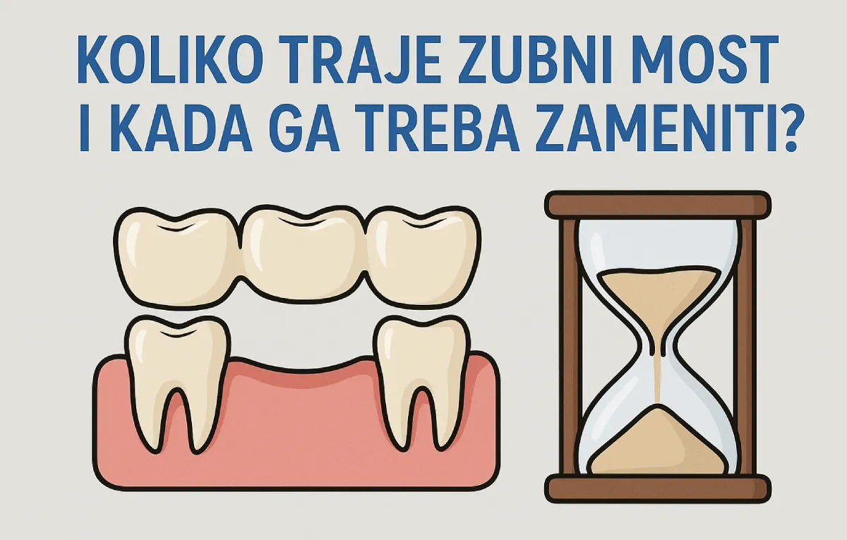Koliko traje zubni most i kada ga treba zameniti? - Zubar Beograd
