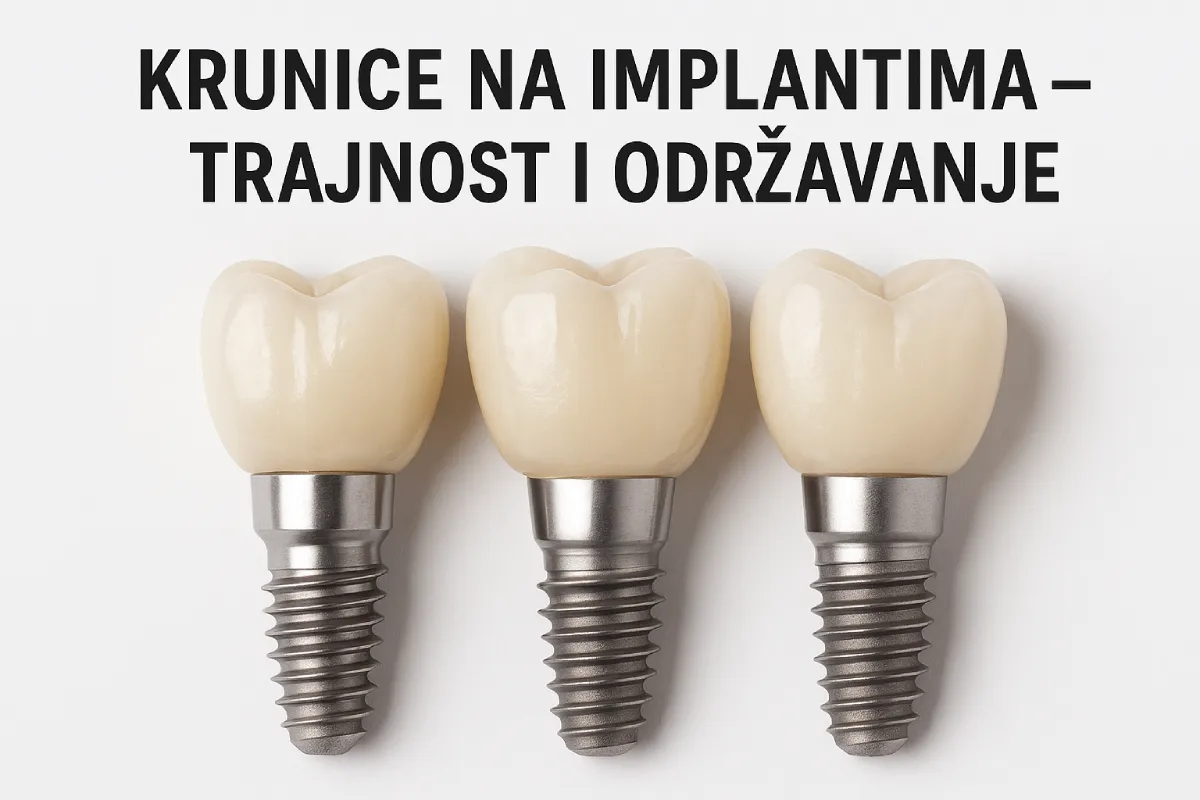 Krunice na implantima – trajnost i održavanje - Zubar Beograd