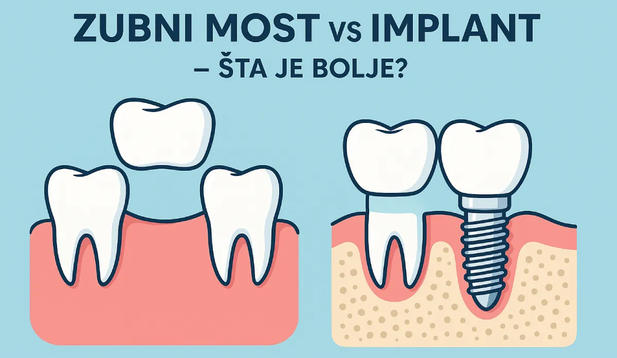Zubni most vs implant – šta je bolje? - Zubar Beograd